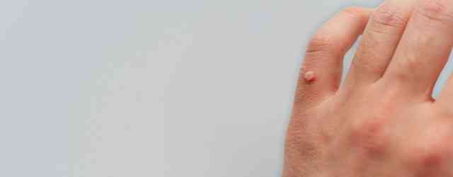 Warts Treatment | Rejuvenation Calgary North | Danny Guo MD