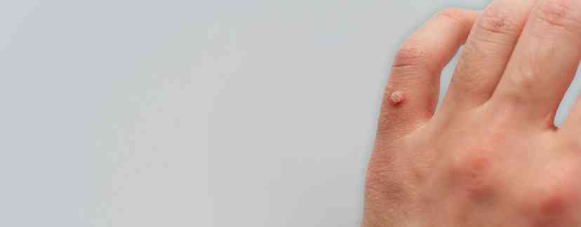 Warts Treatment | Rejuvenation Calgary North | Danny Guo MD